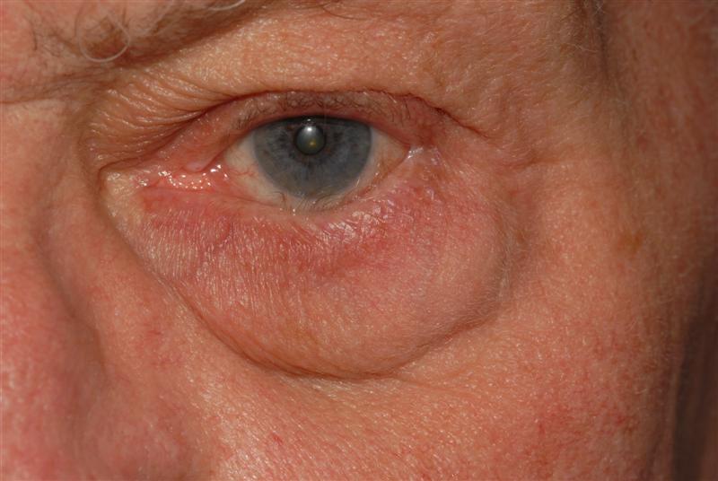 Redness On Eyelid Pictures Photos