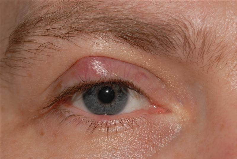 Eyelid cysts - BOPSS