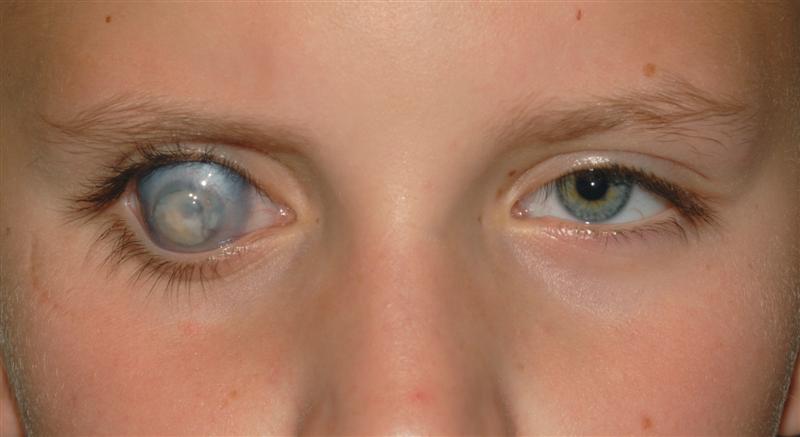 Removal of an Eye, Artificial Eyes, and Socket Care - BOPSS