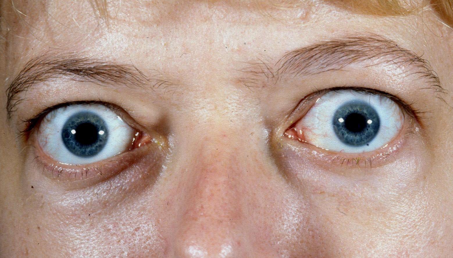 Thyroid eye disease (TED) - BOPSS